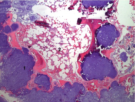 Chondroma (Enchondroma) | Radiology Key