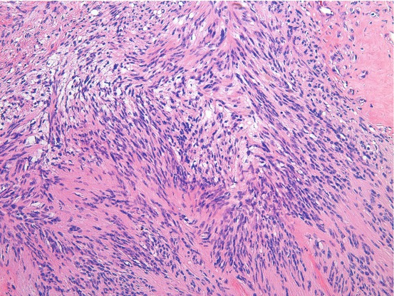 Schwannoma (Neurilemoma, Neurinoma) | Radiology Key