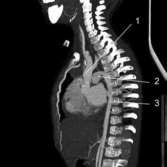 Thoracic Angiography | Radiology Key