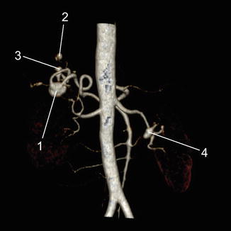 Abdominal Angiography | Radiology Key