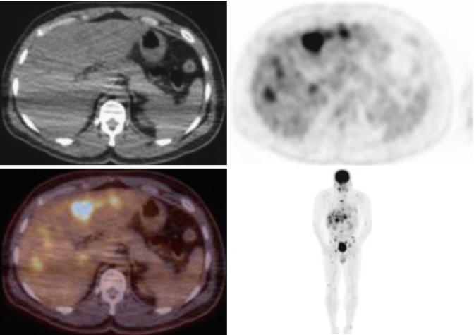 Nuclear Oncology 2: Scintigrahic Imaging | Radiology Key