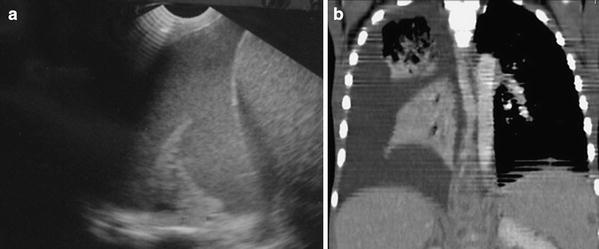 Tuberculosis | Radiology Key