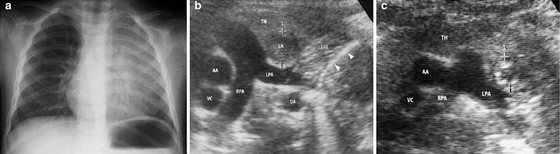 Study of the Pediatric Chest | Radiology Key