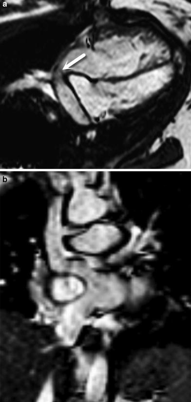 Cardiac MRI | Radiology Key