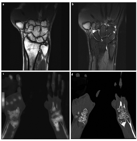 CT and MR: Integration in Degenerative Musculoskeletal Diseases ...