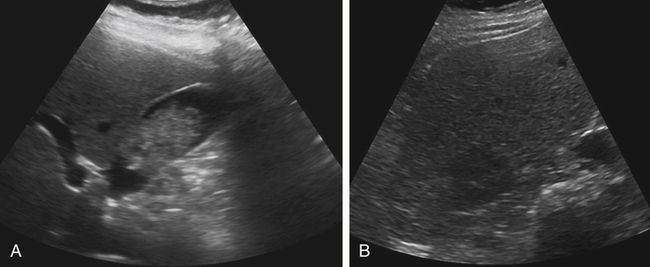 Right Upper Quadrant Pain | Radiology Key