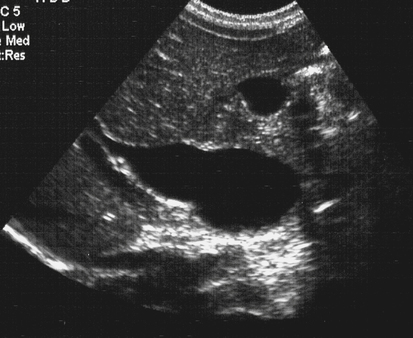 Neonatal Spinal Dimple | Radiology Key