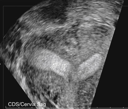 Infertility | Radiology Key