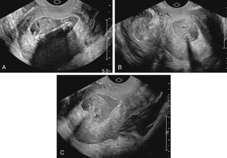 II: Gynecology | Radiology Key