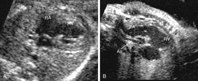Neonatal Spinal Dimple | Radiology Key