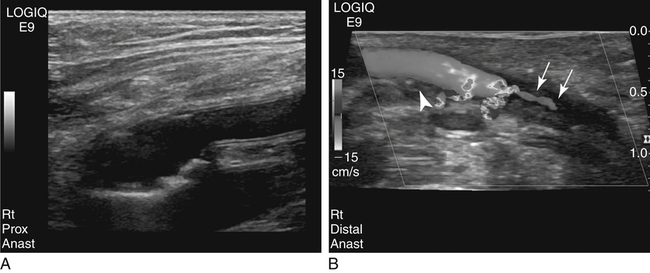 Claudication: Peripheral Arterial Disease | Radiology Key