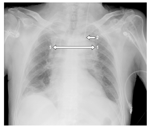 Central lines | Radiology Key