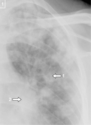 Tuberculosis (TB) | Radiology Key
