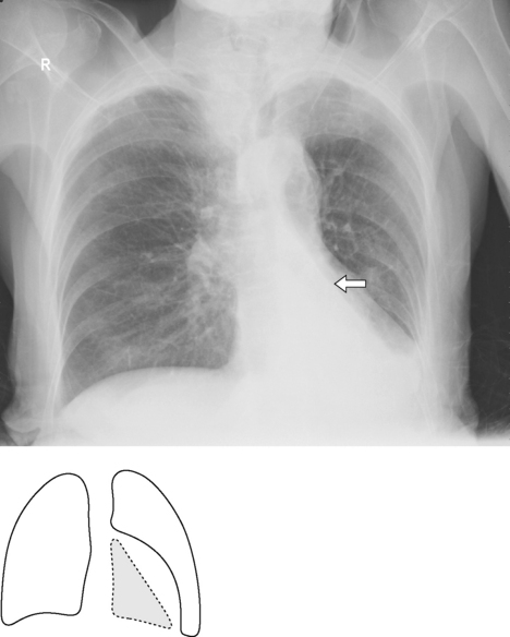 Lobar collapses | Radiology Key