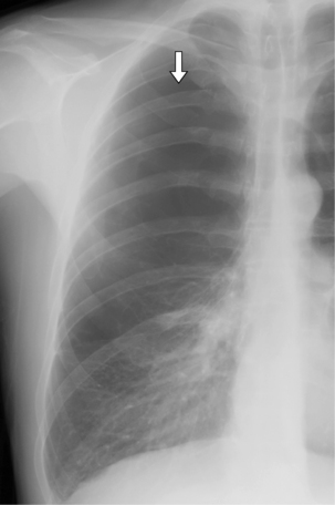 Pneumothorax | Radiology Key