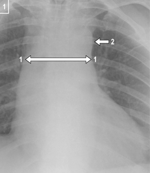 Aortic dissection | Radiology Key
