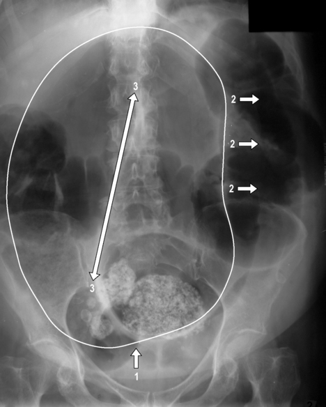 Sigmoid volvulus | Radiology Key