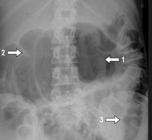 Sigmoid volvulus | Radiology Key