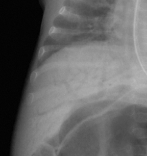 Pneumatosis intestinalis | Radiology Key