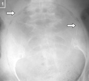 Emphysematous cystitis | Radiology Key