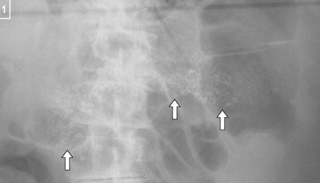 Gallstones | Radiology Key