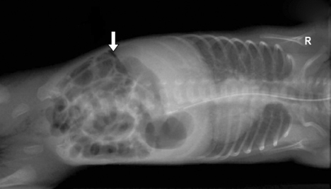 Pneumoperitoneum – AXR | Radiology Key