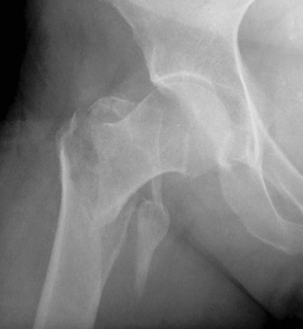 Hip fractures | Radiology Key