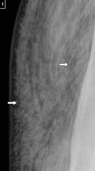 Gas gangrene | Radiology Key