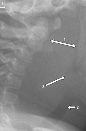 Retropharyngeal abscess | Radiology Key