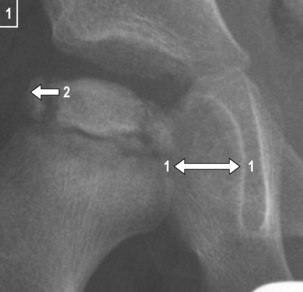 Perthes’ disease | Radiology Key