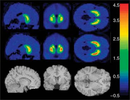 Psychiatric Disorders | Radiology Key