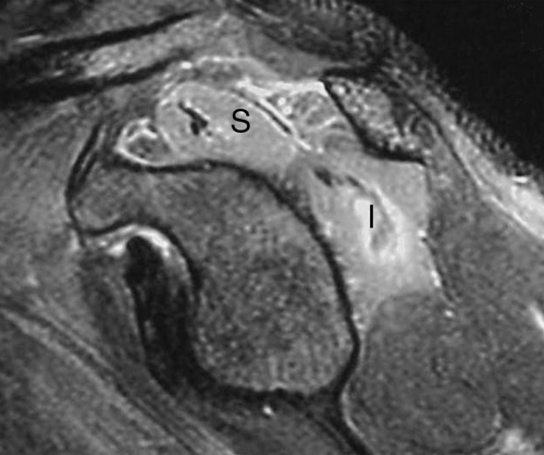 Magnetic Resonance Imaging of the Shoulder | Radiology Key