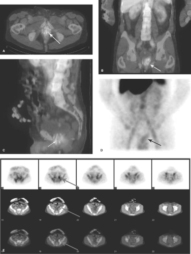 Genitourinary System Scintigraphy | Radiology Key