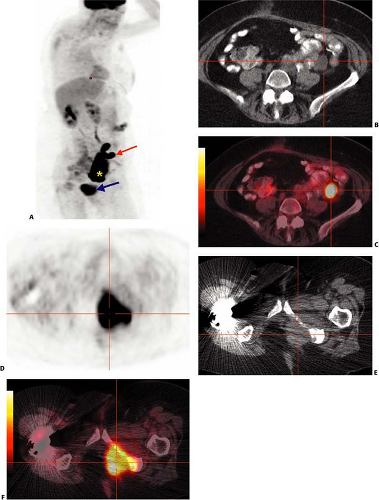 Genitourinary Malignancies Radiology Key