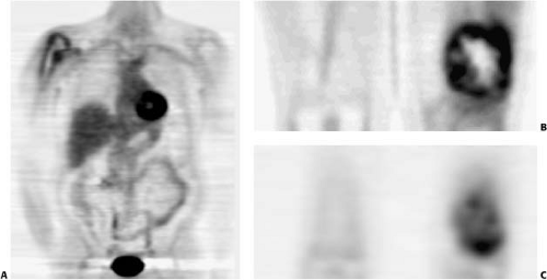 Sarcomas | Radiology Key