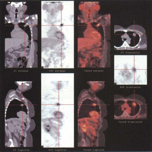 Principles of Cancer Imaging with 18-F Fluorodeoxyglucose (FDG ...