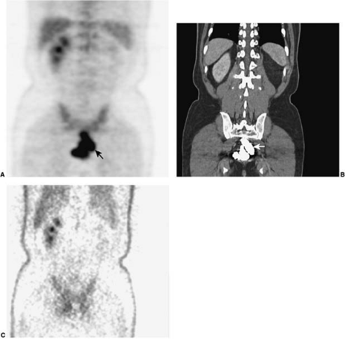 Artifacts and Normal Variants in FDG PET | Radiology Key