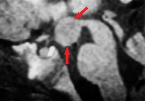 Central Nervous System Neoplasms and Tumor-Like Masses | Radiology Key