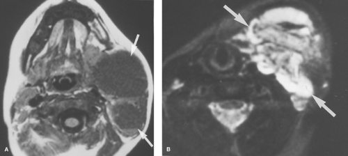 Head and Neck Imaging | Radiology Key