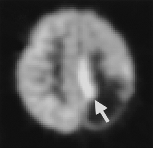 Movement Disorders, Stroke, and Epilepsy | Radiology Key