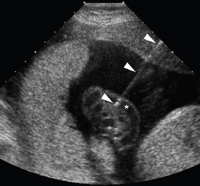 Diagnostic Obstetrical Procedures | Radiology Key