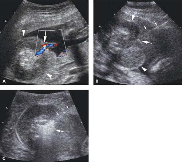 Therapeutic Obstetrical Procedures | Radiology Key