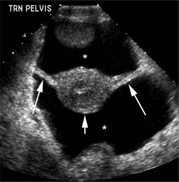 Adnexa | Radiology Key