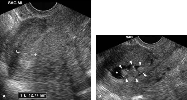Endometrium | Radiology Key
