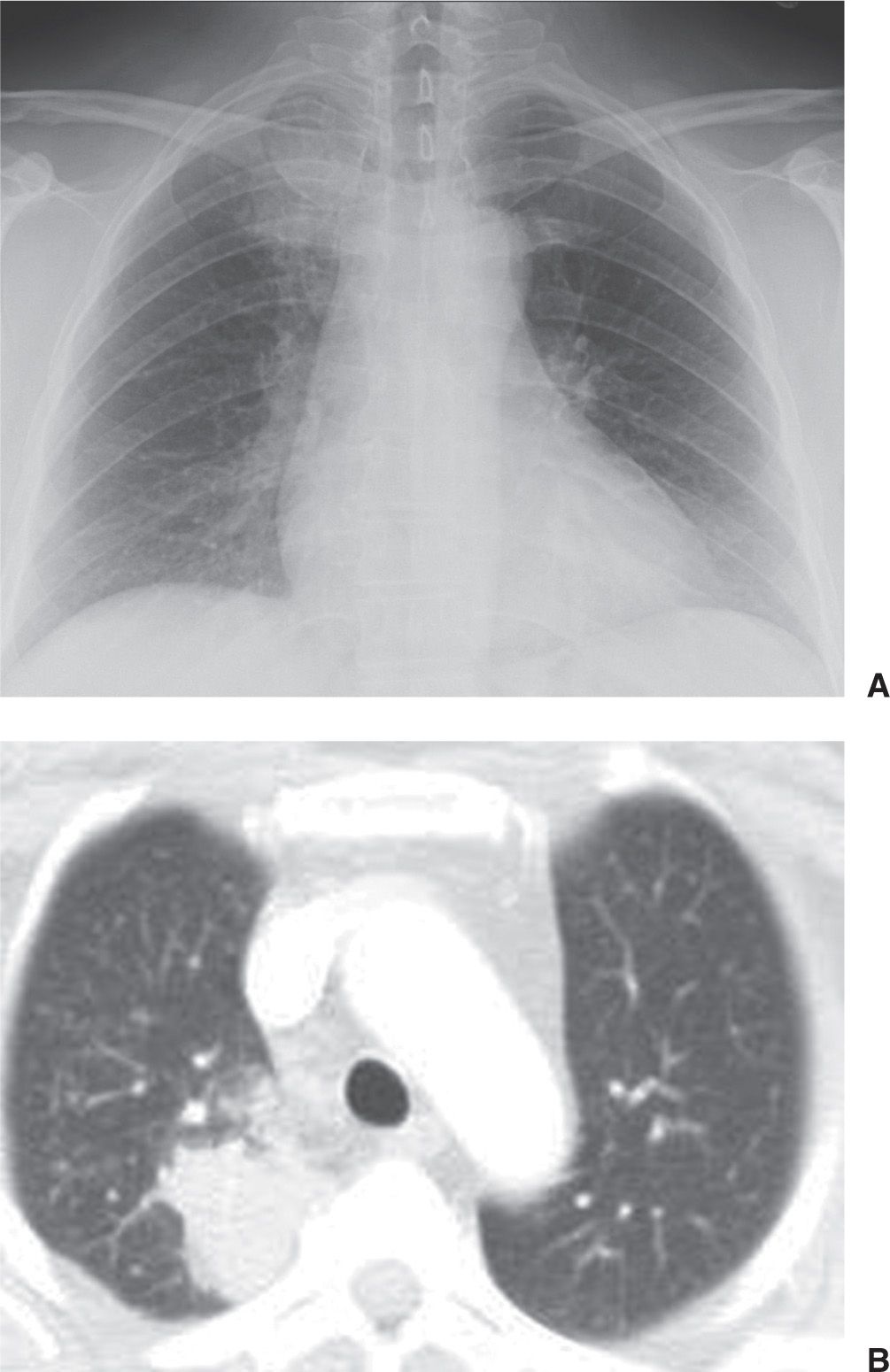 Alveolar Lung Disease | Radiology Key