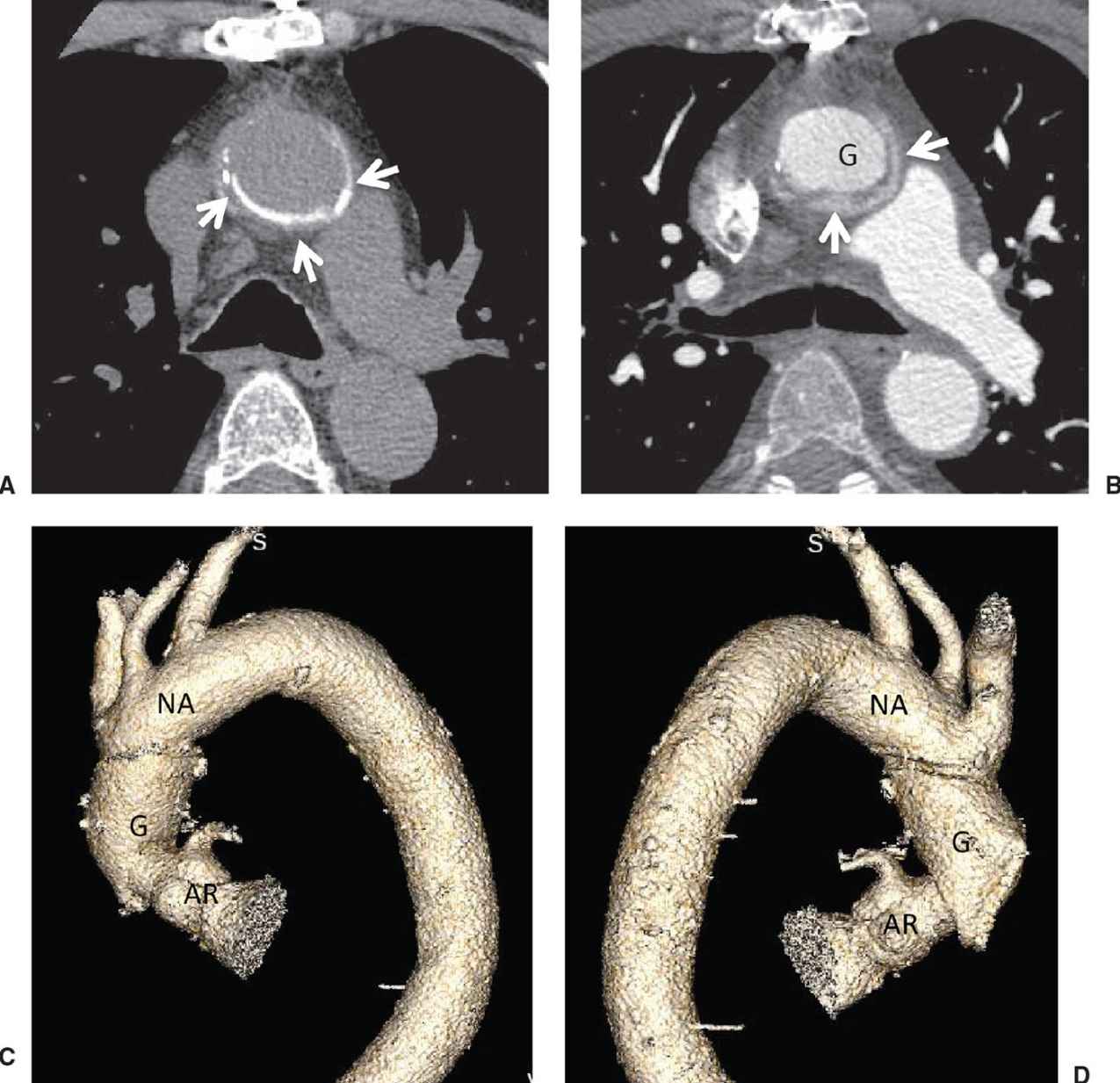 Thoracic Aorta | Radiology Key