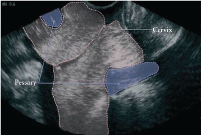 Imaging of the Uterine Cervix | Radiology Key