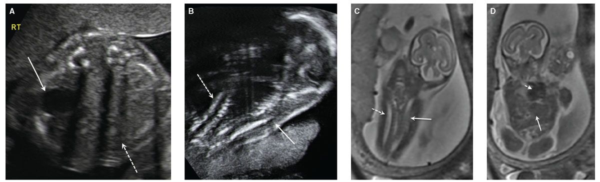 Multiple Gestation | Radiology Key