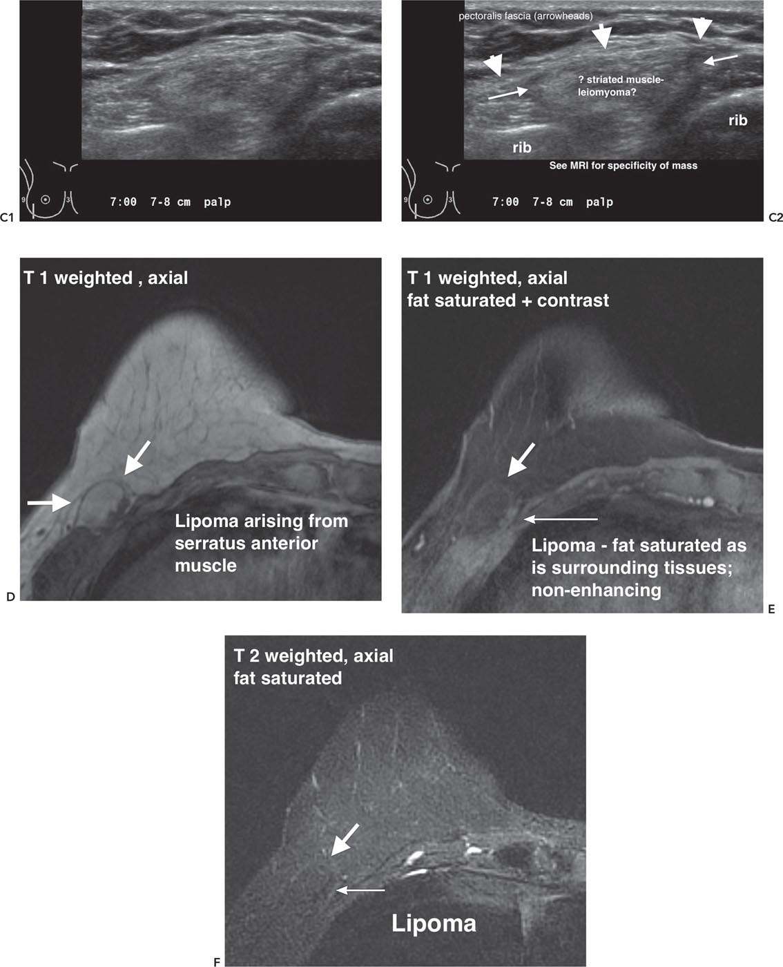 A: Oval/Lobular | Radiology Key