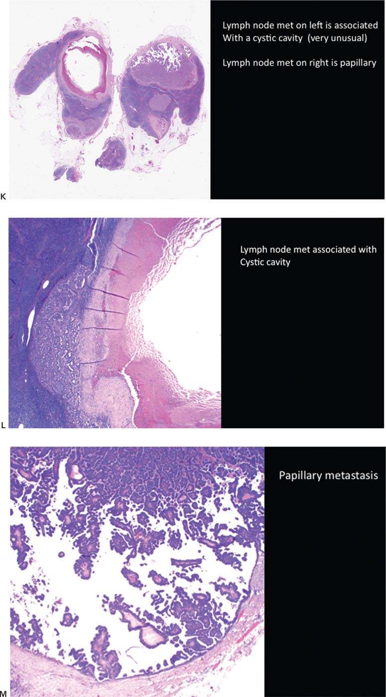 A: Circumscribed | Radiology Key